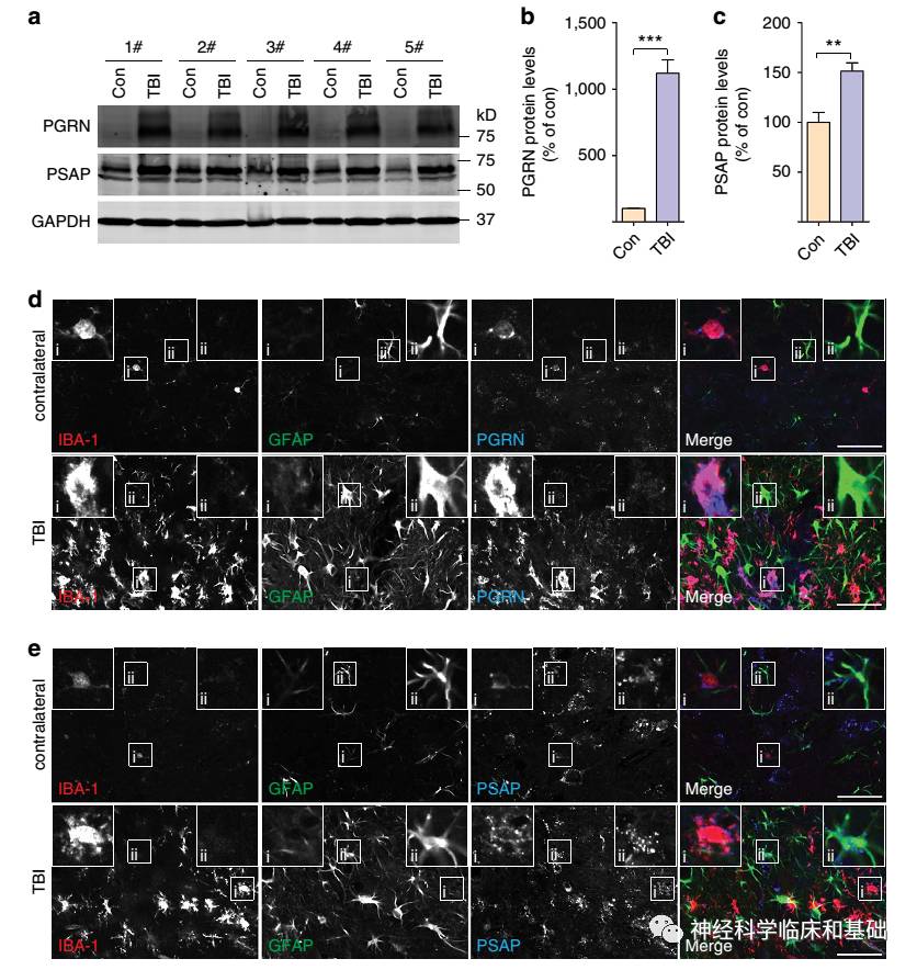 科学网—Nature Communi——额颞叶痴呆PGRN突变导致prosaposin运输异常 - 陈之春的博文