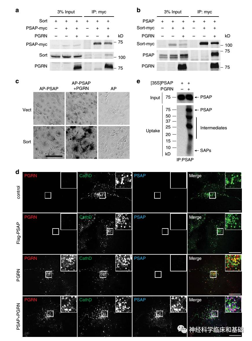 科学网—Nature Communi——额颞叶痴呆PGRN突变导致prosaposin运输异常 - 陈之春的博文